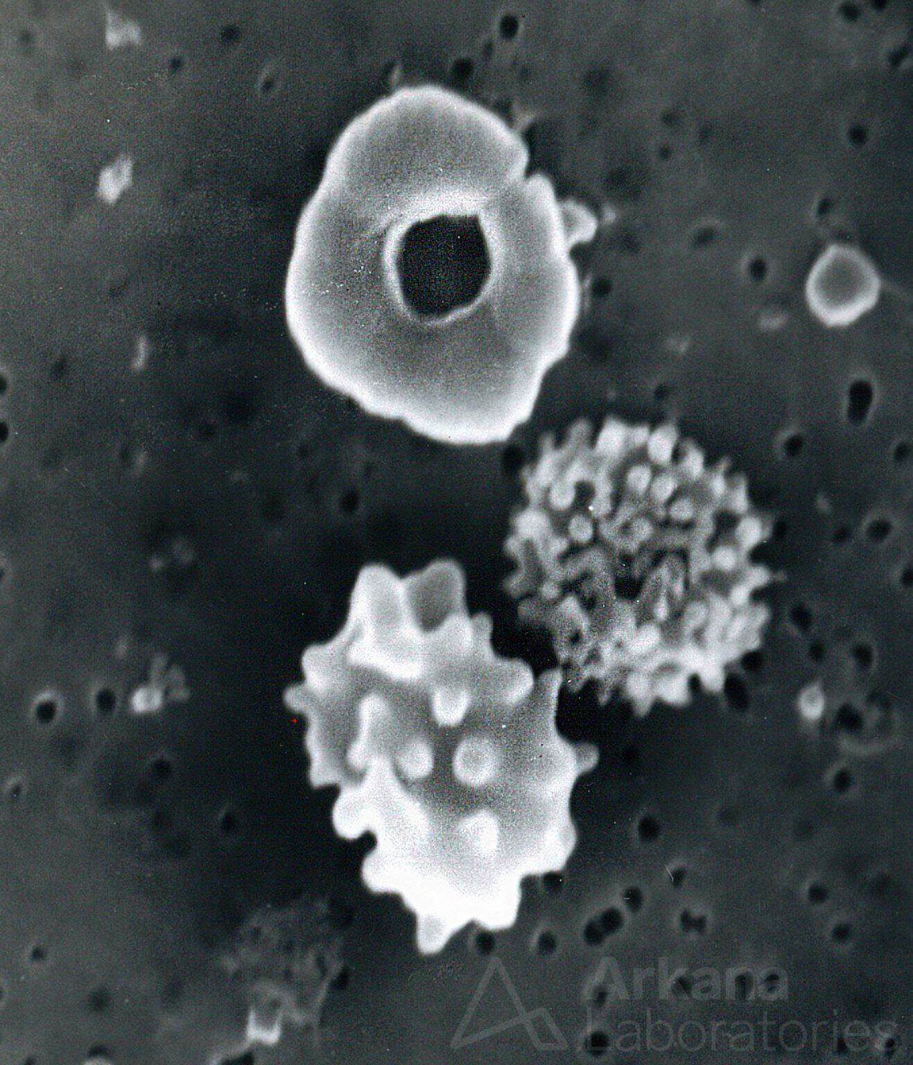 Dysmorphic Red Blood Cells | eyeSCANdy | Arkana Laboratories