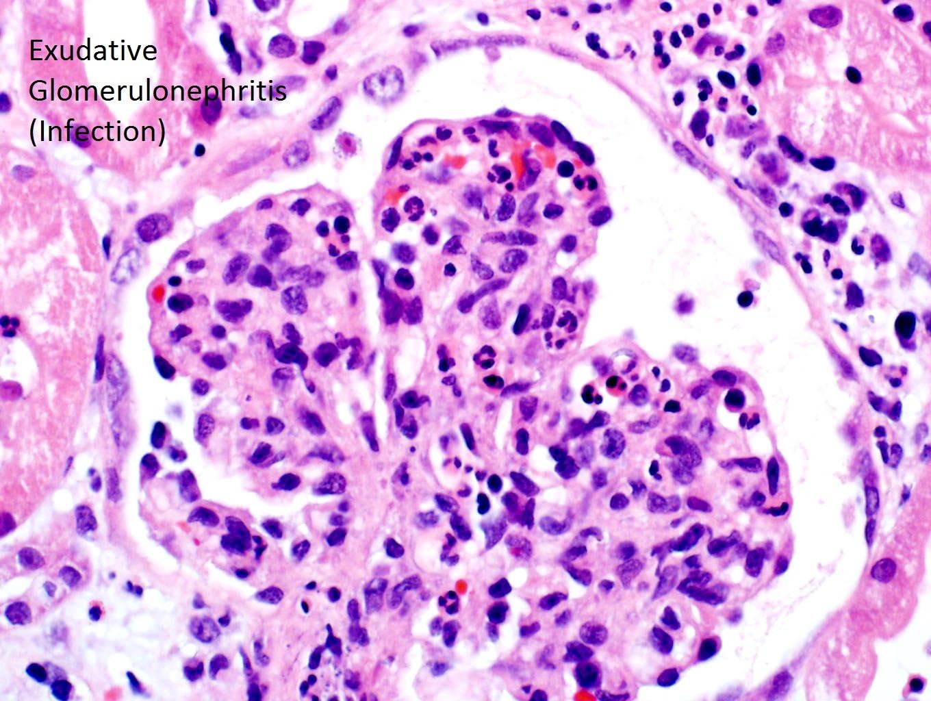 C3 Glomerulonephritis | Disease Week | Arkana Laboratories