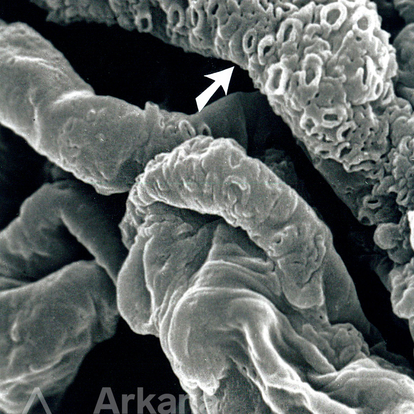 Spicular Amyloid Deposit | eyeSCANdy | Arkana Laboratories