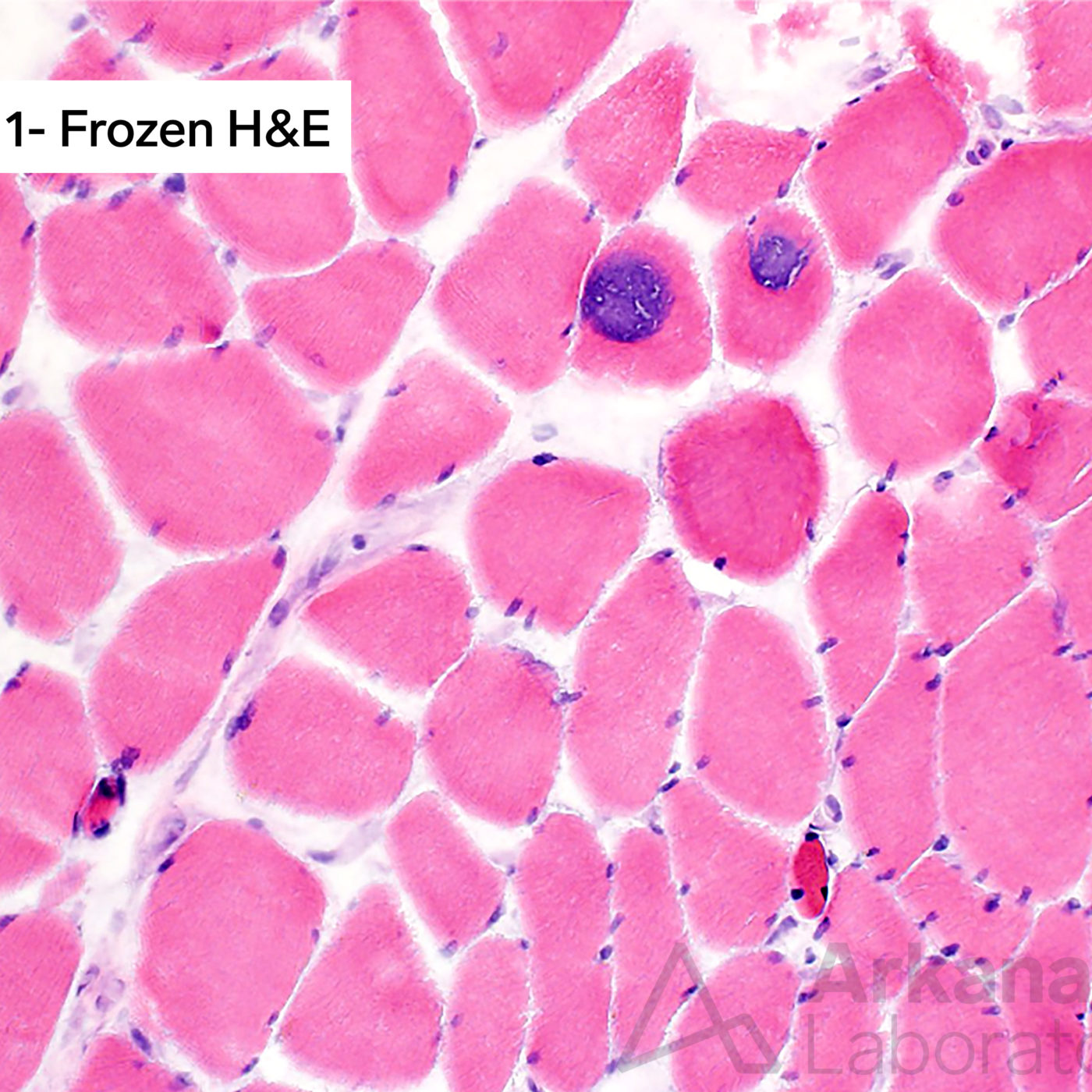 Nephronophthisis by Light Microscopy - Arkana Laboratories