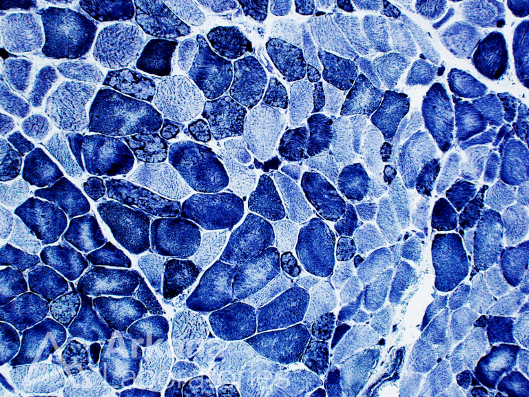 Lobulated Muscle Fibers | Neuro Notes | Arkana Labs