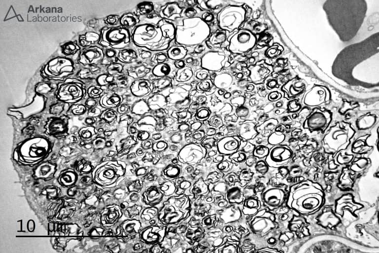 Fabry's Disease | Diagnose This! | Arkana Laboratories