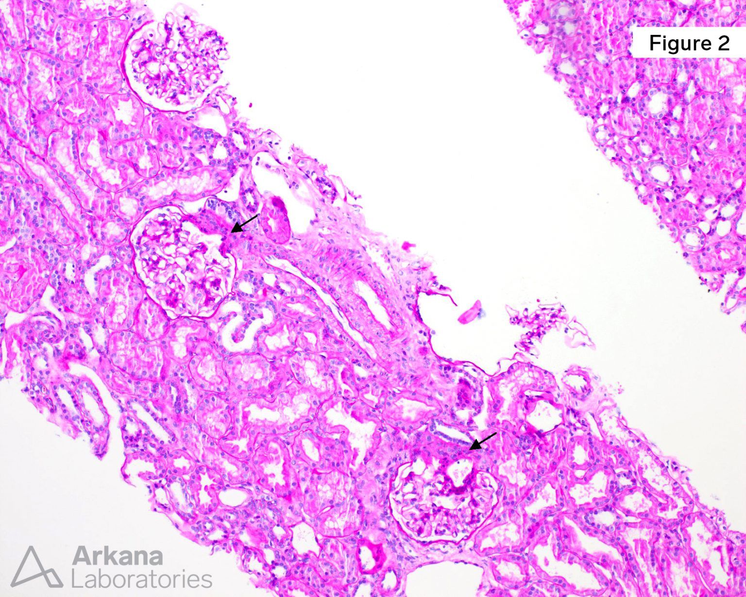 Pediatric Nephrotic Syndrome | Teaching Point | Arkana Laboratory