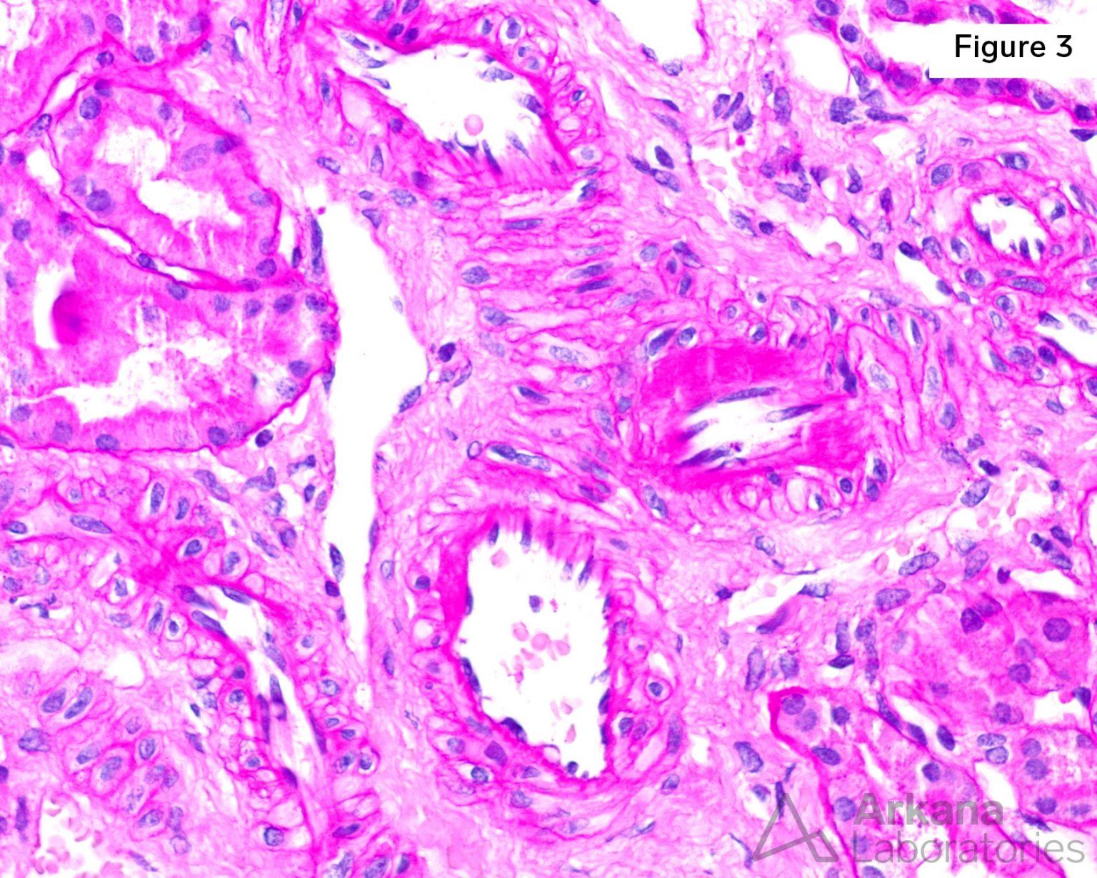Pediatric Nephrotic Syndrome | Teaching Point | Arkana Laboratory
