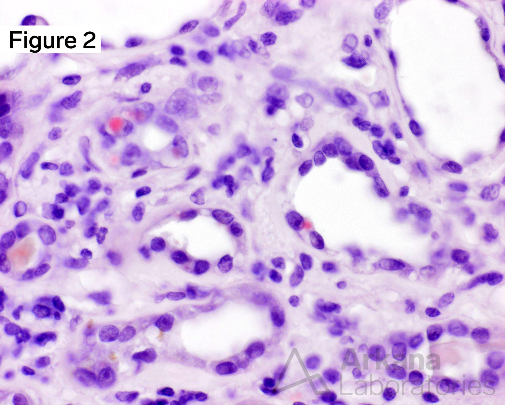 Amyloid Proximal Tubulopathy | Diagnose This! | Arkana Labs