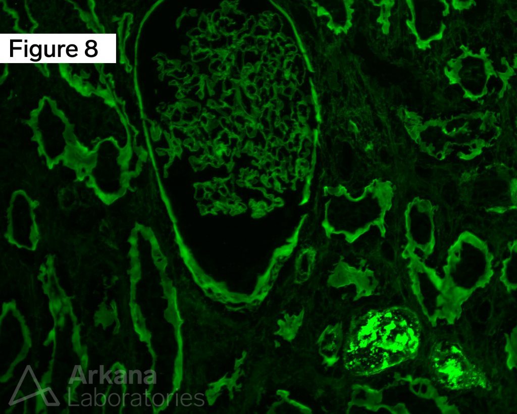 Amyloid Proximal Tubulopathy | Diagnose This! | Arkana Labs