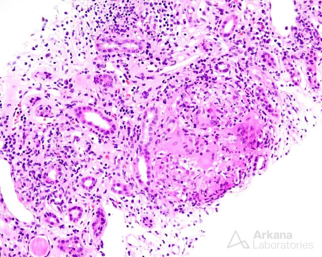 Sarcoidosis | Diagnose This! | Arkana Laboratories