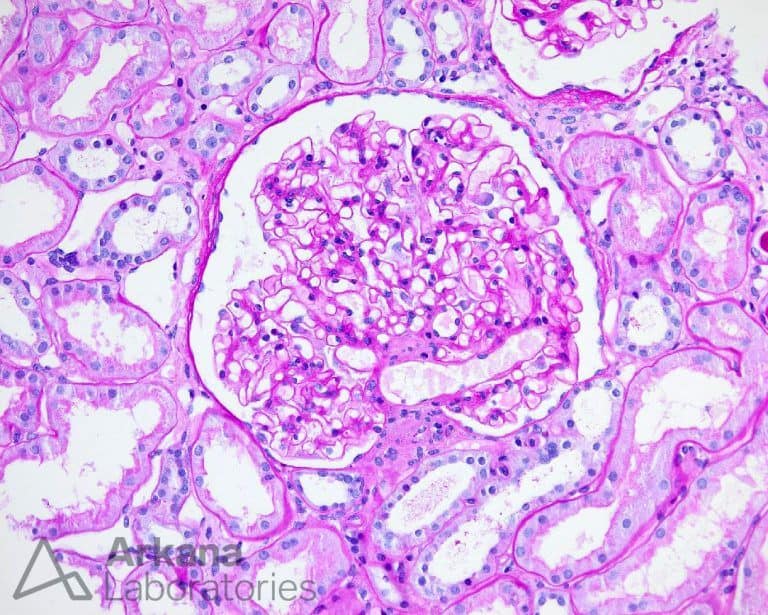 Glomerulomegaly | Diagnose This! | Arkana Laboratories