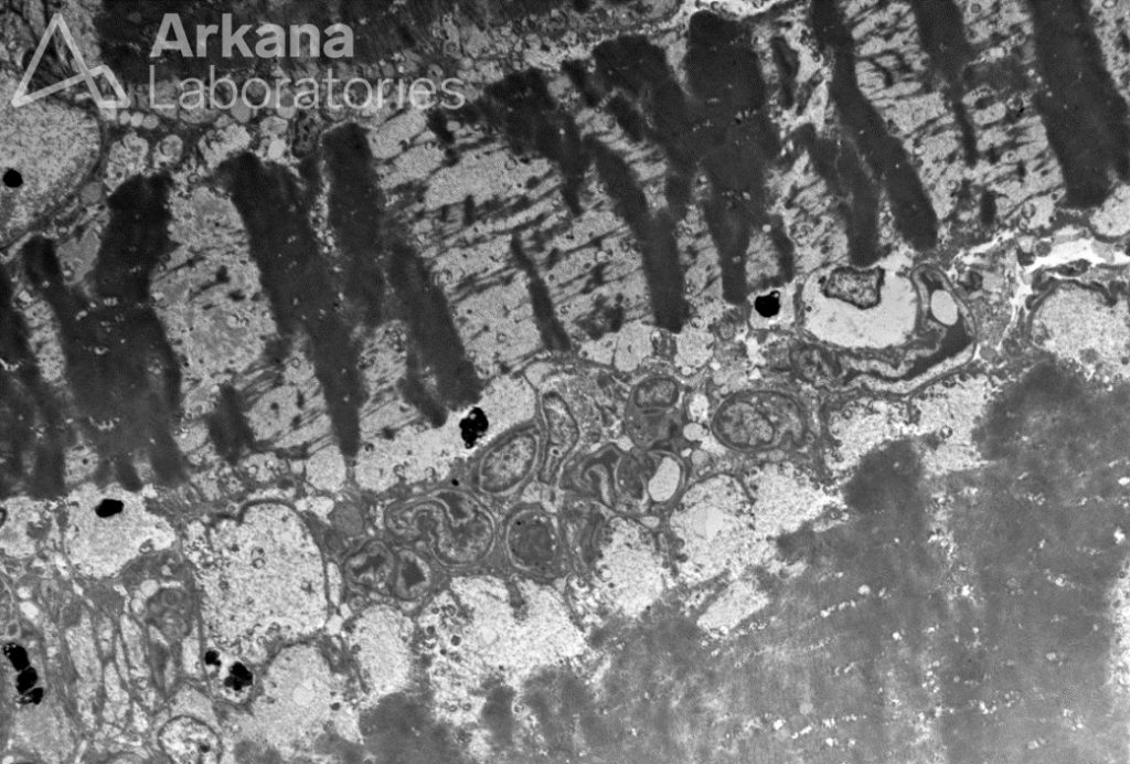 Contraction Band Artifact | Neuro Notes | Arkana Laboratories