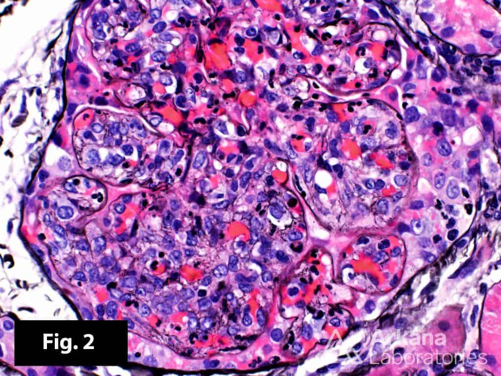 Acute Post Infectious Glomerulonephritis Teaching Points Arkana Labs