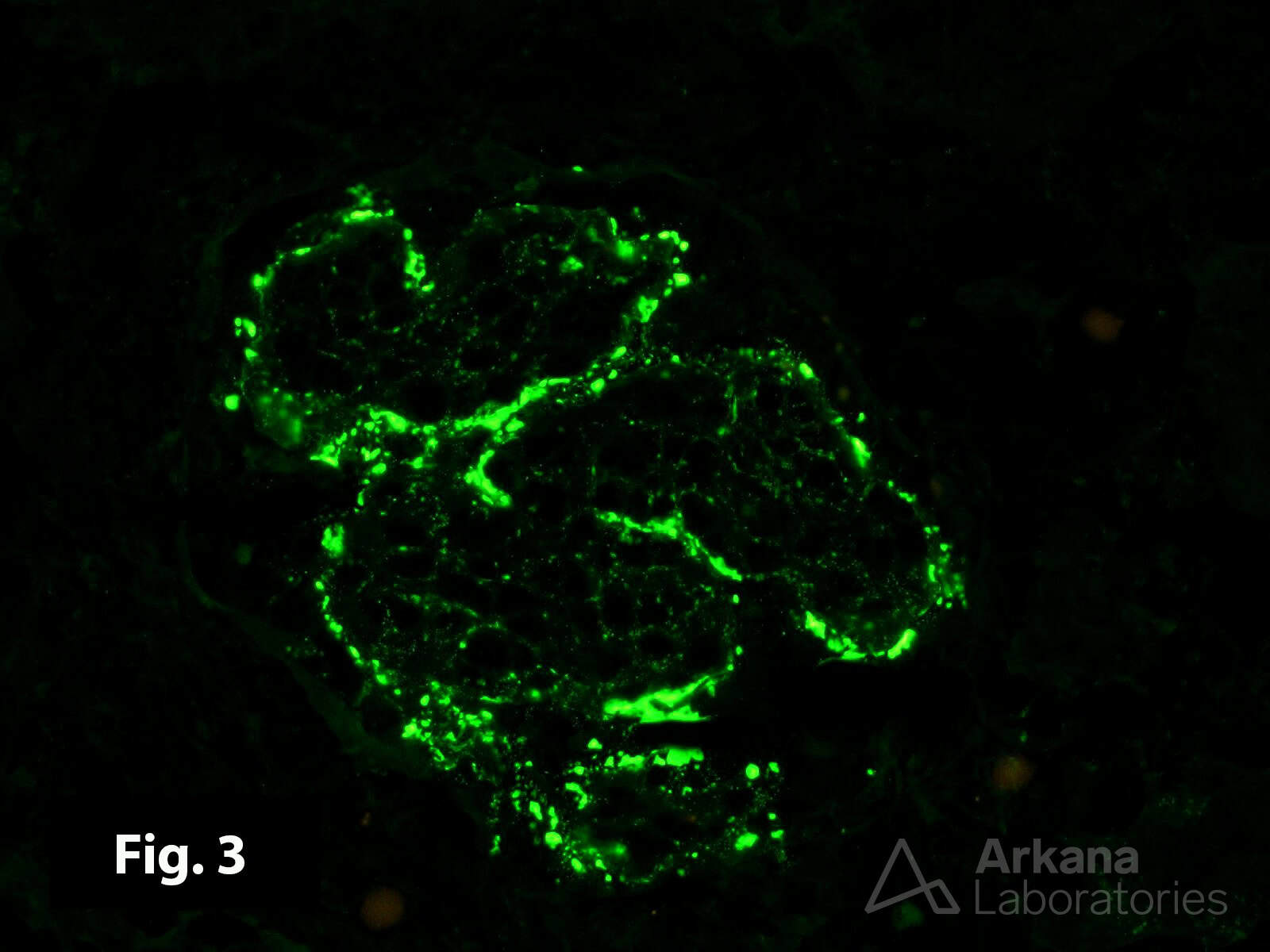 Acute Post Infectious Glomerulonephritis Teaching Points Arkana Labs