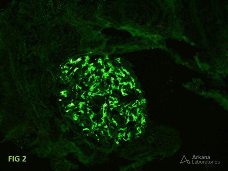 IgA Nephropathy | Teaching Points | Arkana Laboratories