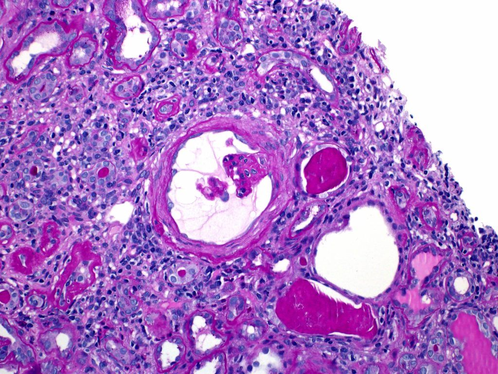HIV-associated nephropathy (HIVAN) | Pushing Glass