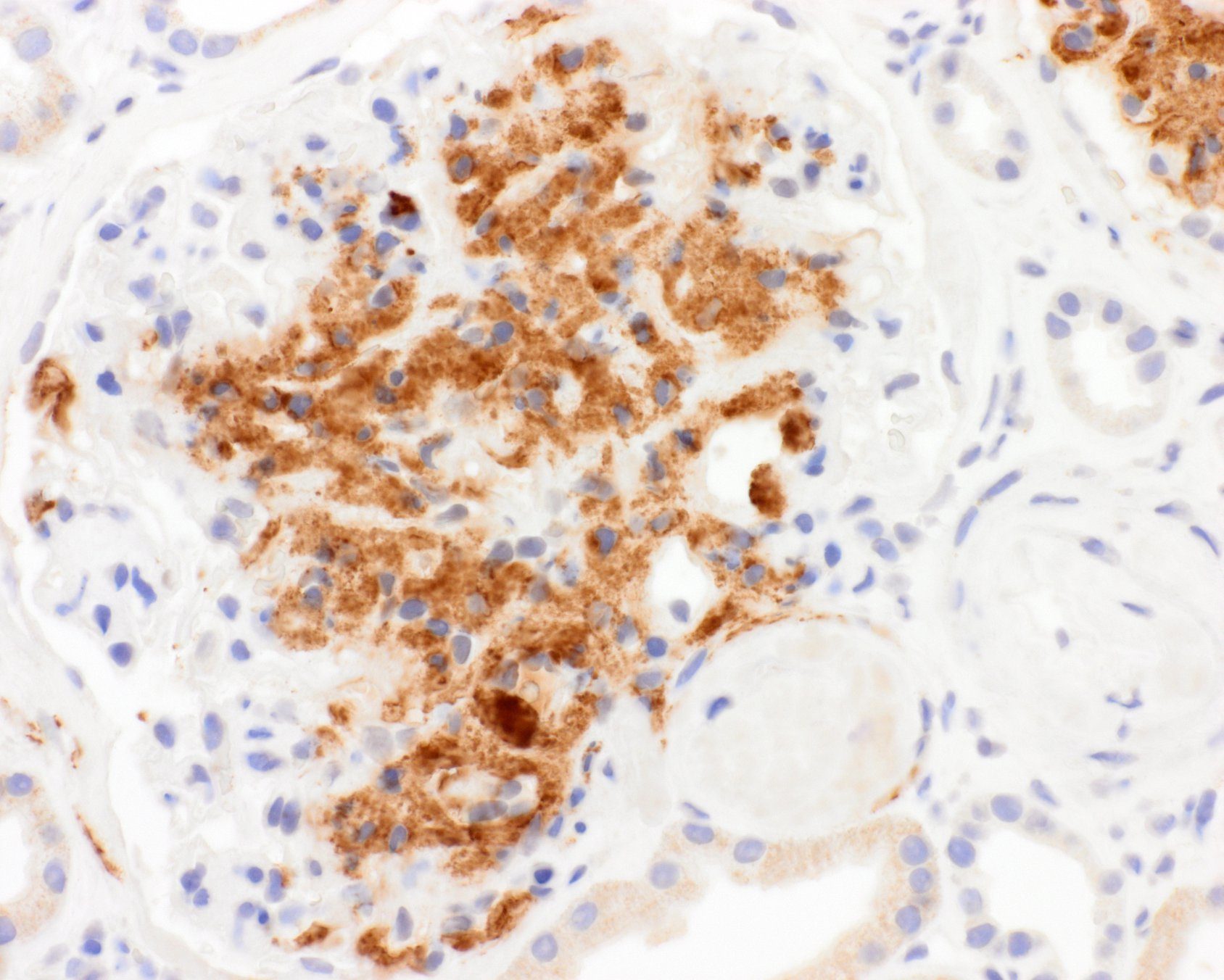 Fibrillary Glomerulopathy (FGN) | Diagnose This! | Arkana Laboratories