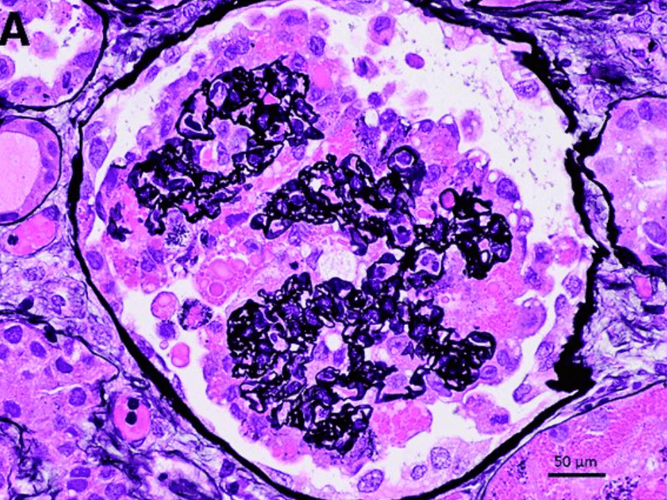 Renal Pathology Quiz 2 For Nephrologists and Nephropathologists