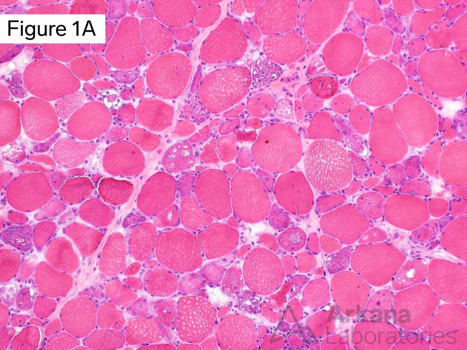 Vacuolar Myopathy | Neuro Notes | Arkana Laboratories