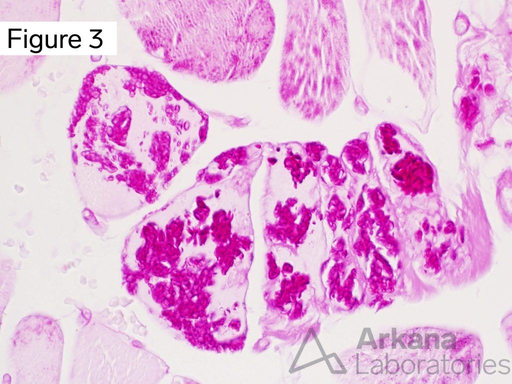 Muscle Inclusions and Polyglucosan Bodies | Neuro Notes | Arkana Labs