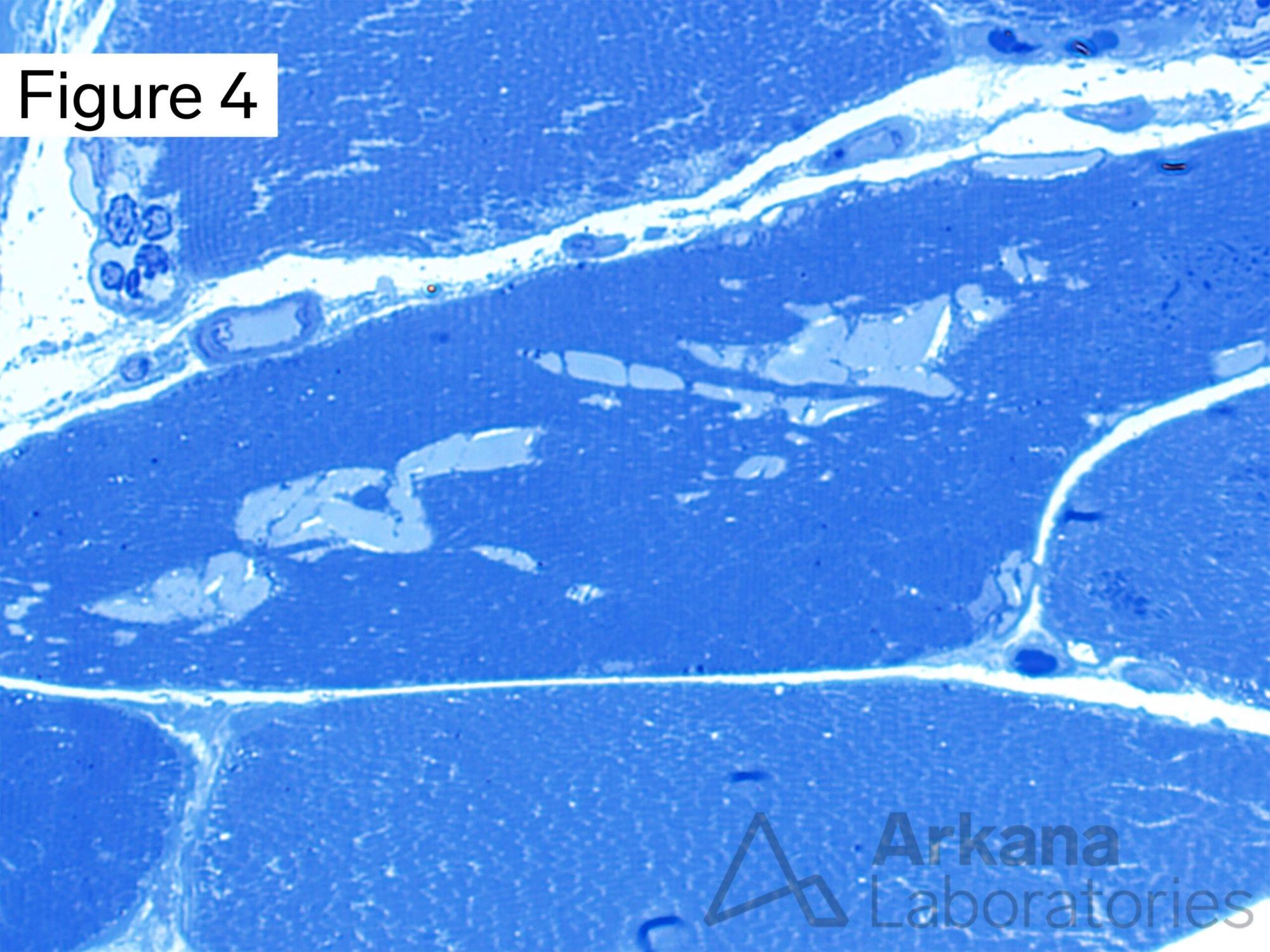 Muscle Inclusions and Polyglucosan Bodies | Neuro Notes | Arkana Labs