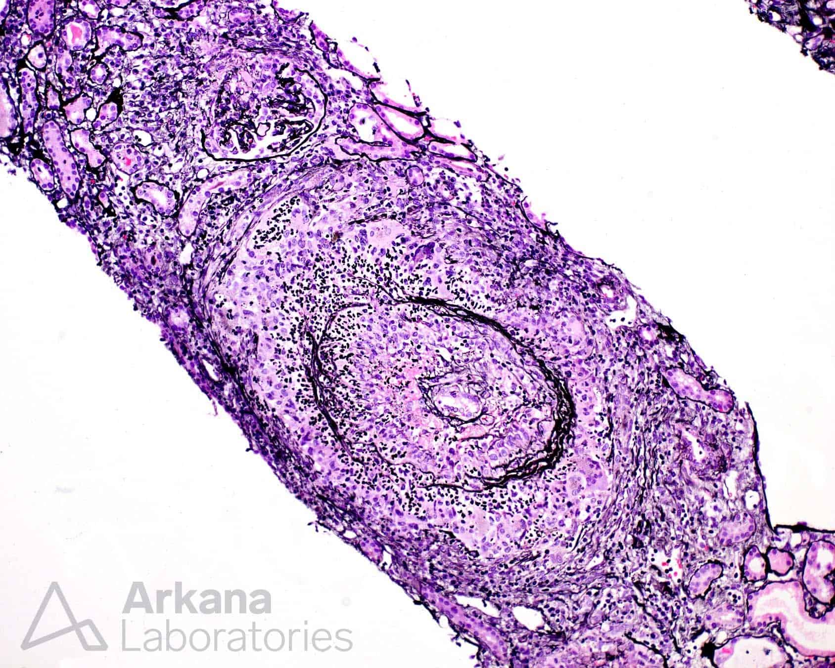 ANCA-associated Vasculitis (AAV) | Disease Week | Arkana Laboratories