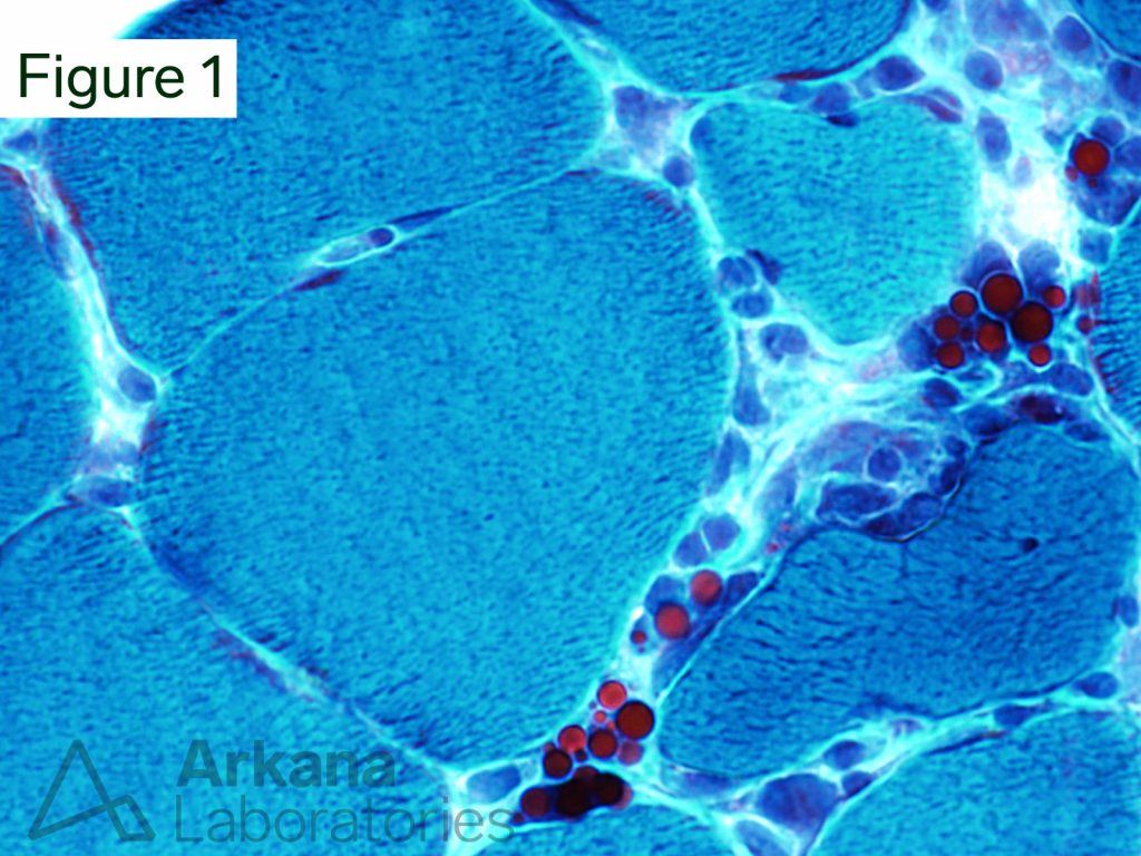 Russell Bodies on Gomori Trichrome Stain | Neuro Notes | Arkana Labs