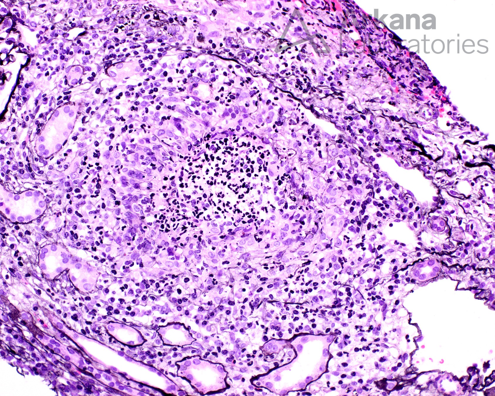 ANCA-associated Vasculitis (AAV) | Disease Week | Arkana Laboratories