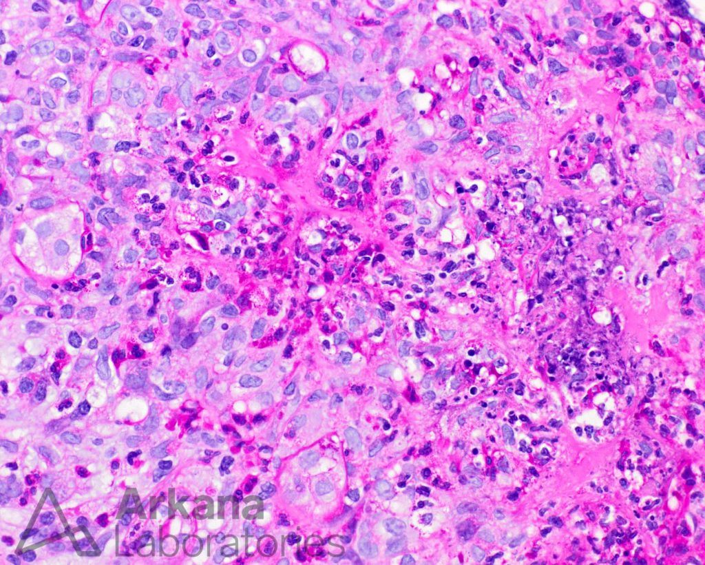 ANCA-associated Vasculitis (AAV) | Disease Week | Arkana Laboratories