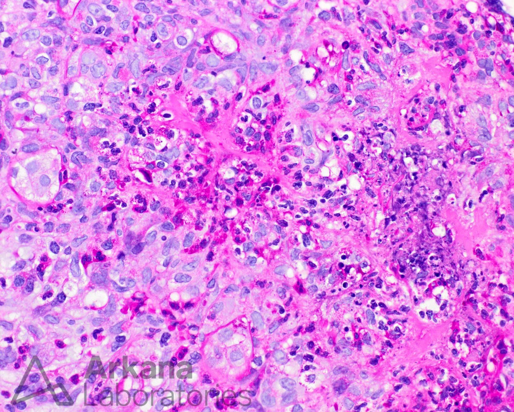 ANCA-associated Vasculitis (AAV) | Disease Week | Arkana Laboratories