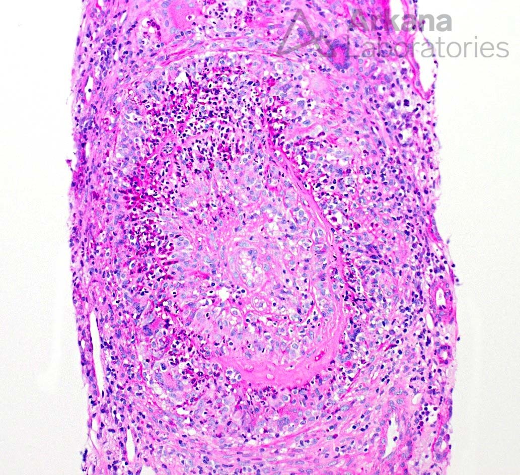 ANCA-associated Vasculitis (AAV) | Disease Week | Arkana Laboratories
