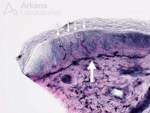 Nerve Fibers In Skin Biopsy | Neuro Notes by Dr. Wilson