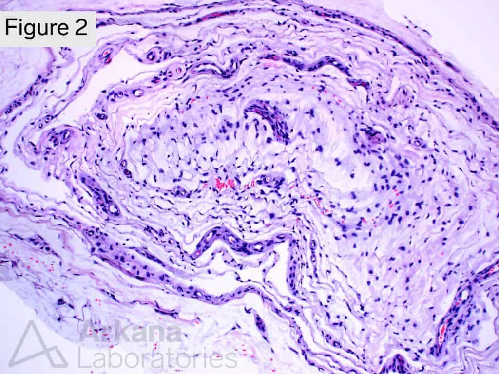 Pacianian Corpuscle in Nerve Biopsy | Neuro Notes with Dr. Wilson