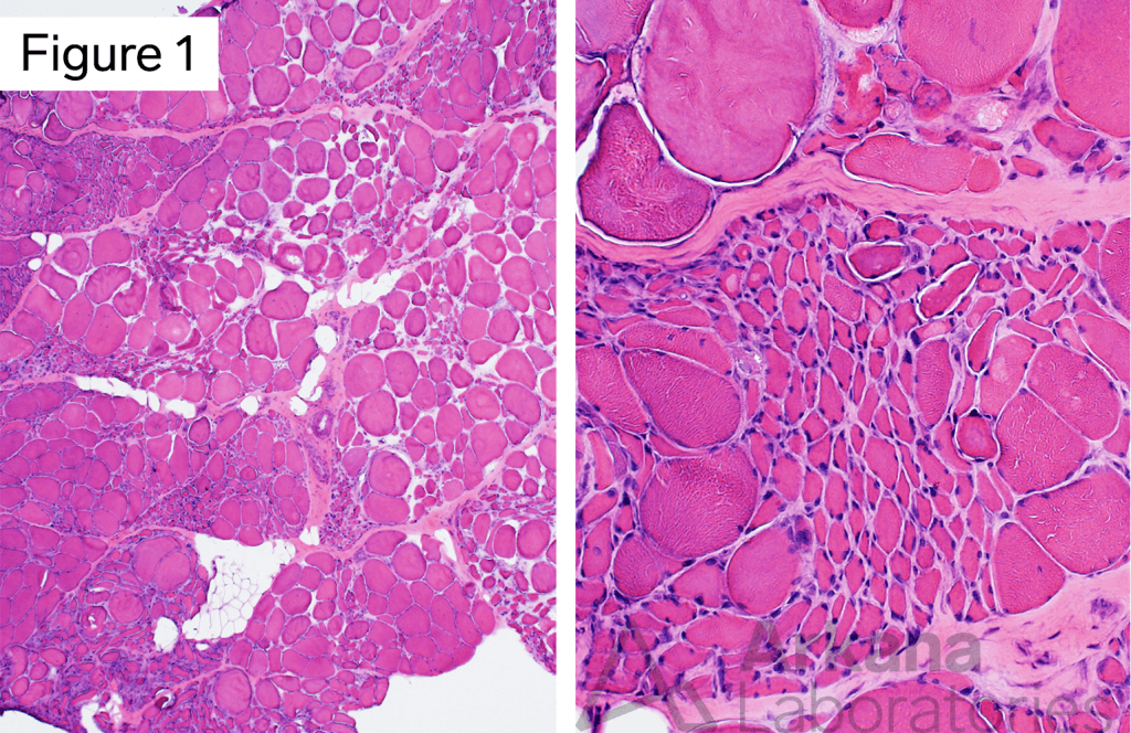 Denervation (Neurogenic Atrophy) | Neuro Notes with Dr. Wilson