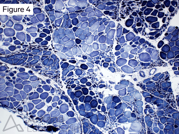 Denervation (Neurogenic Atrophy) | Neuro Notes with Dr. Wilson