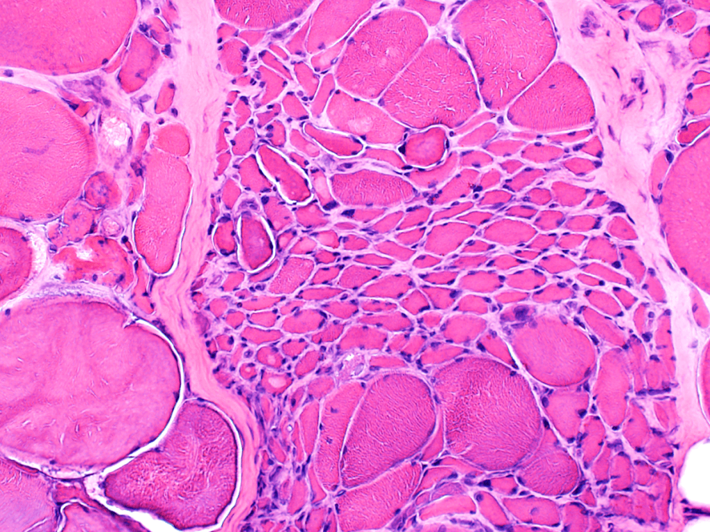 Denervation (Neurogenic Atrophy) | Neuro Notes with Dr. Wilson