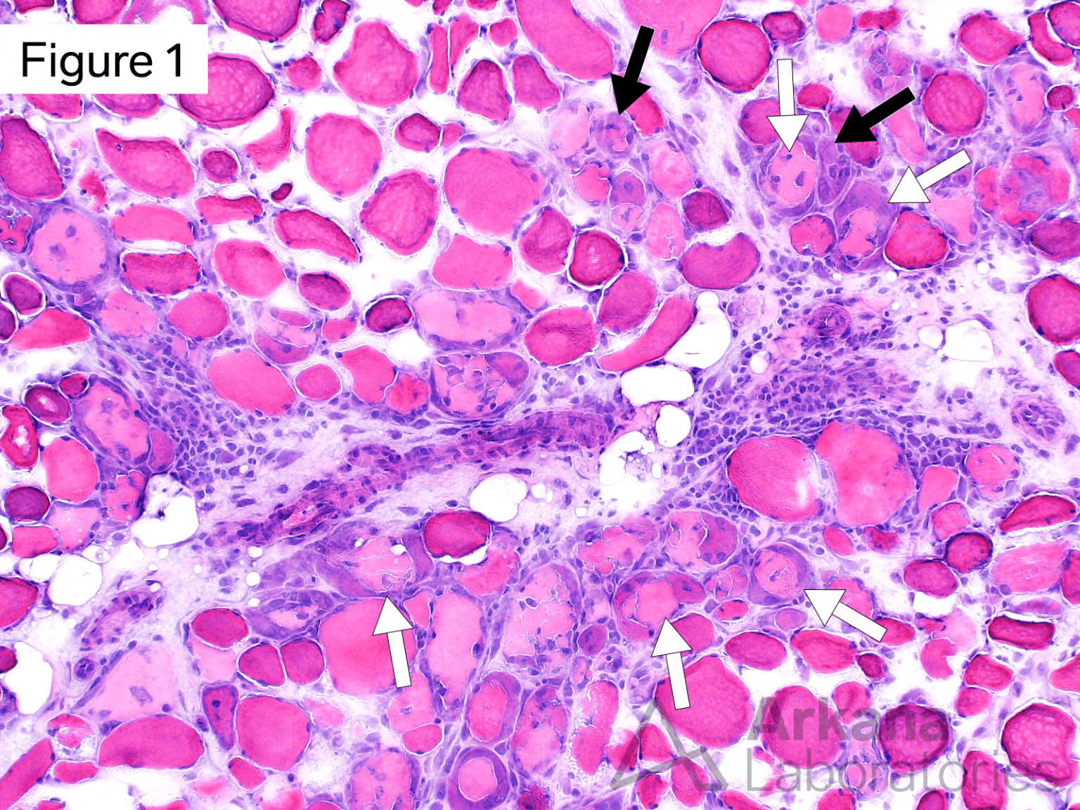 Perifascicular Necrosis | Neuro Notes with Dr. Wilson | Arkana Laboratories