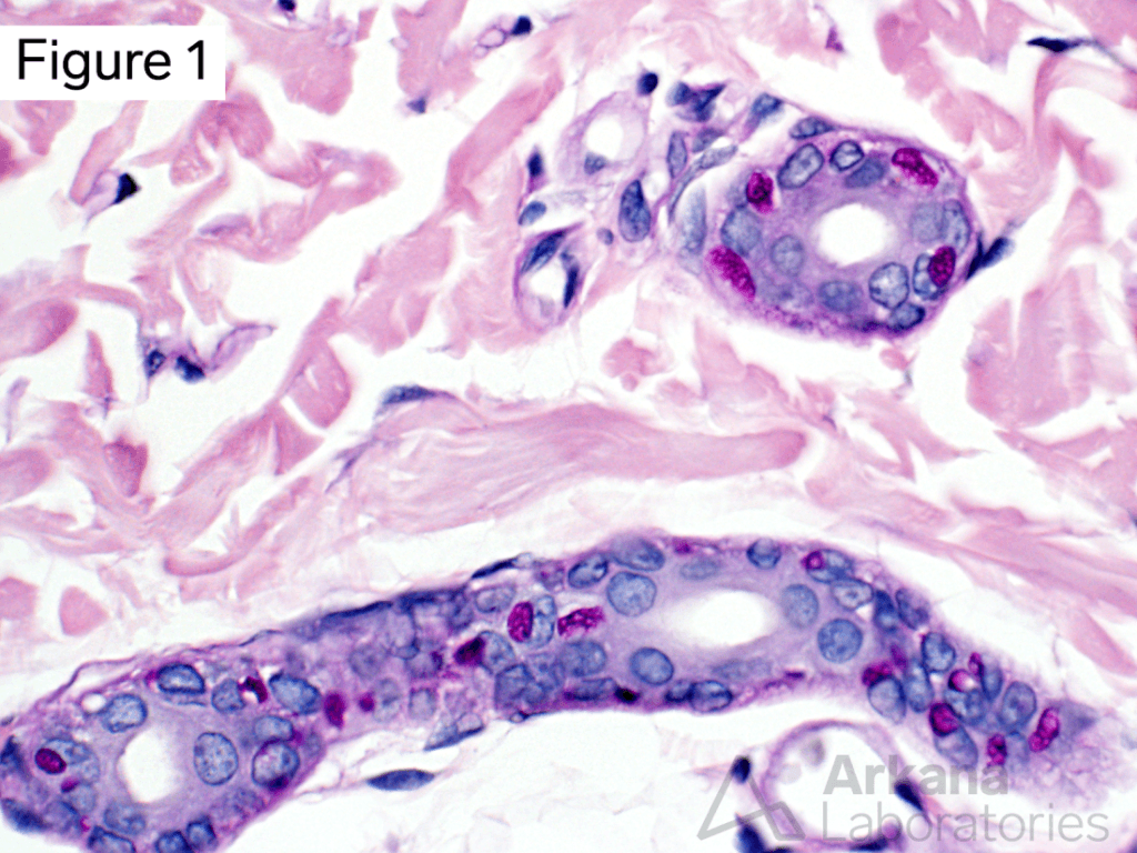 Lafora Bodies in Sweat Gland Cells | Neuro Notes with Dr. Wilson
