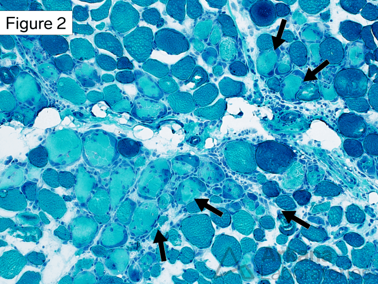 Perifascicular Necrosis | Neuro Notes with Dr. Wilson | Arkana Laboratories