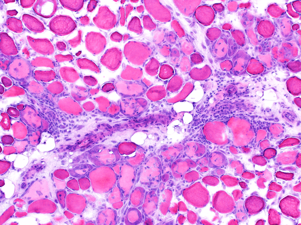 Perifascicular Necrosis | Neuro Notes with Dr. Wilson | Arkana Laboratories
