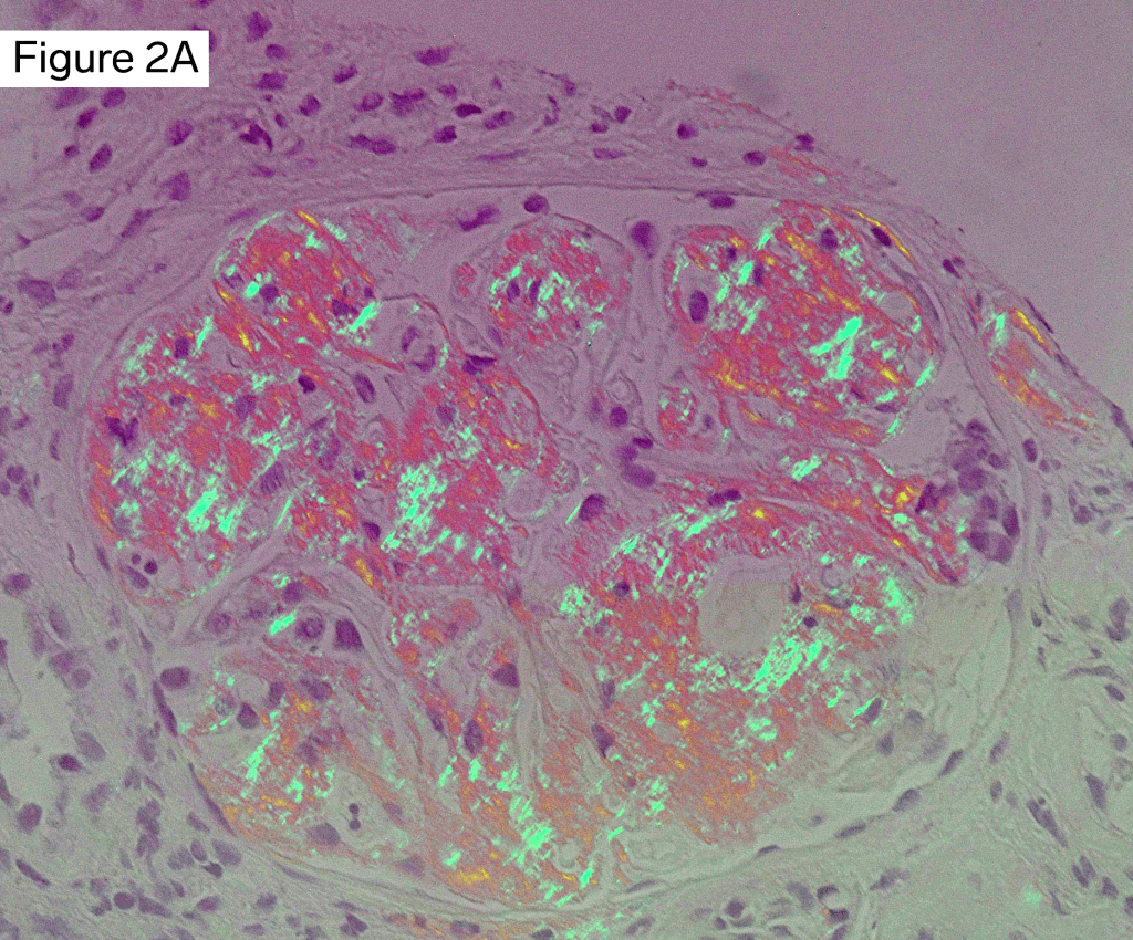 Case 3: A Chameleon in Green | AA Amyloidosis | Renal Review