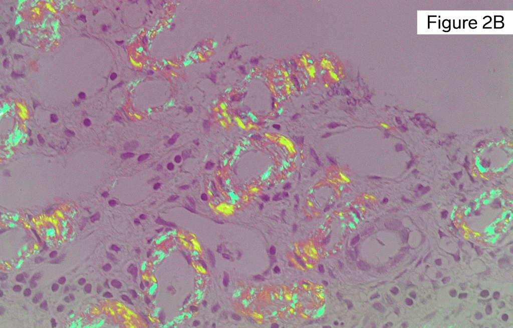 Case 3: A Chameleon in Green | AA Amyloidosis | Renal Review