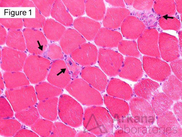 Necrotic Myofibers | Neuro Notes with Dr. Wilson