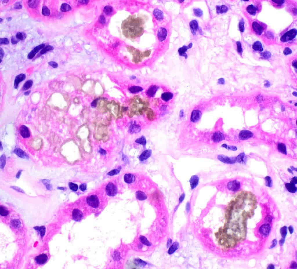 Case 4: A Polarizable Precipitate - Arkana Laboratories