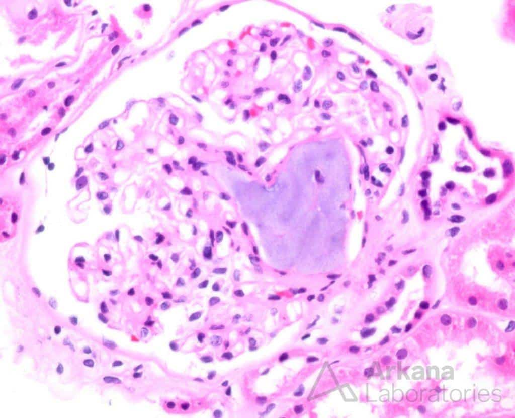 Case 5: An Unusual Embolus - Arkana Laboratories