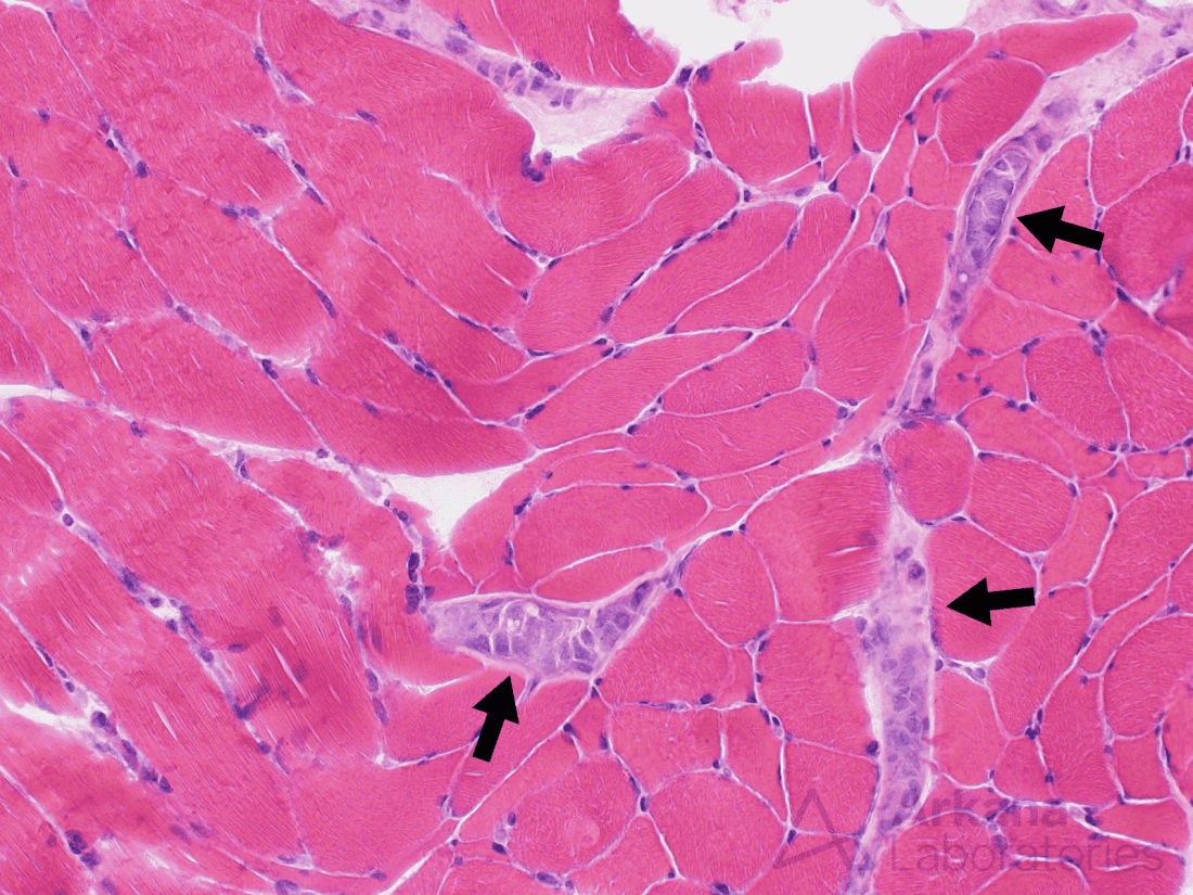 Intravascular lymphoma - Arkana Laboratories
