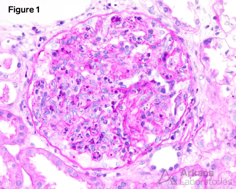 Post Streptococcal Acute Glomerulonephritis PSAGN Case 7