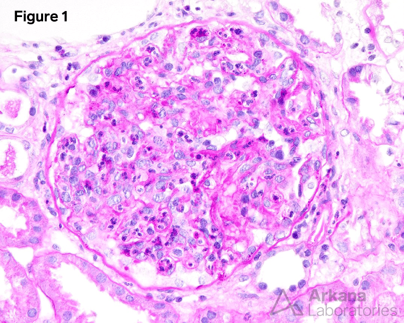 Post Streptococcal Acute Glomerulonephritis PSAGN Case 7