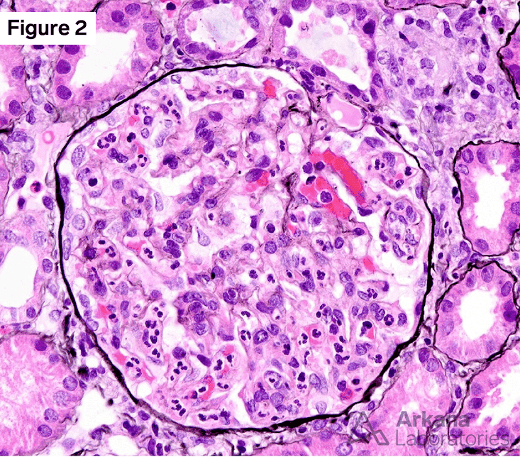 Post Streptococcal Acute Glomerulonephritis PSAGN Case 7