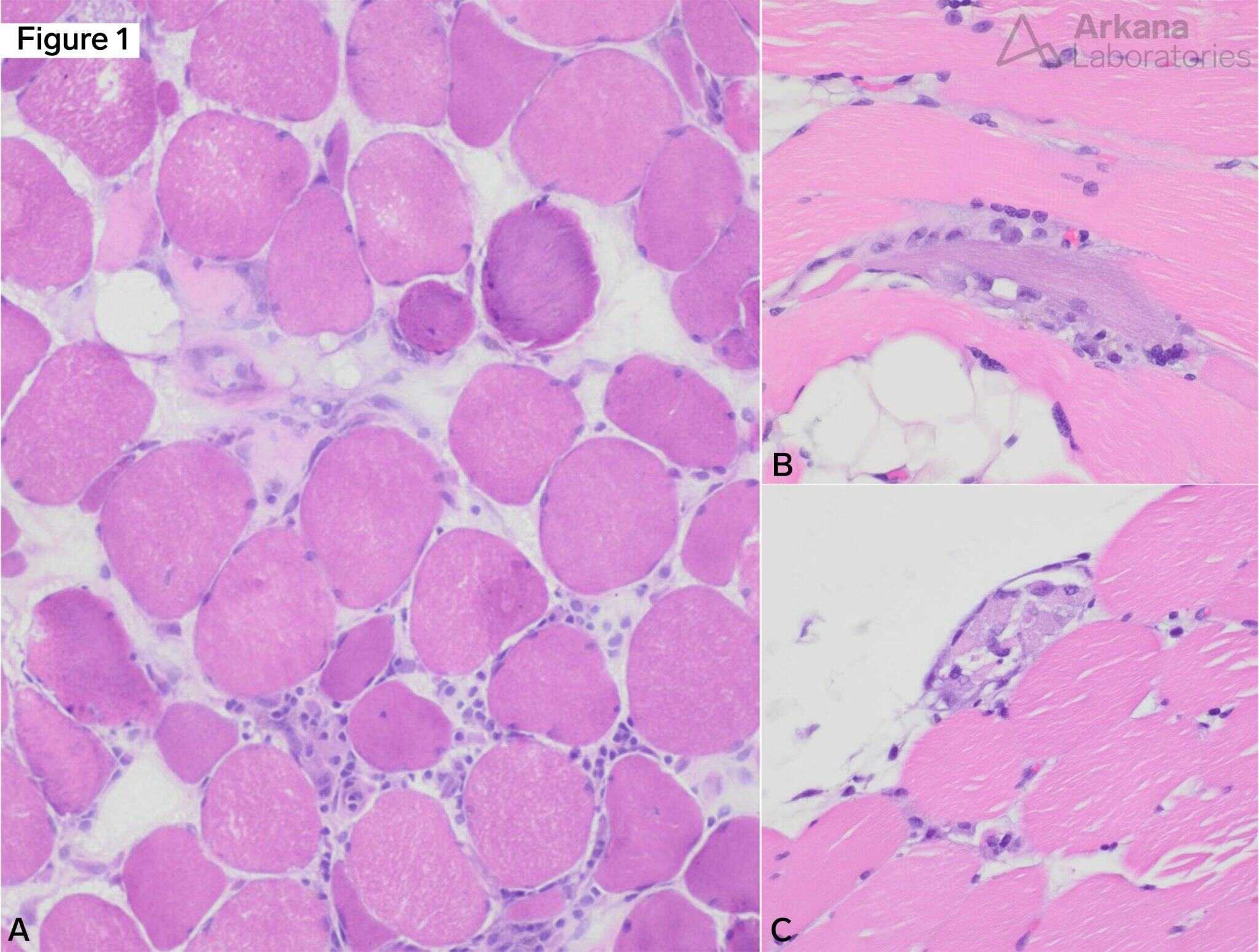 Necrotizing Myopathy - Weakness and Falls | Arkana Labs