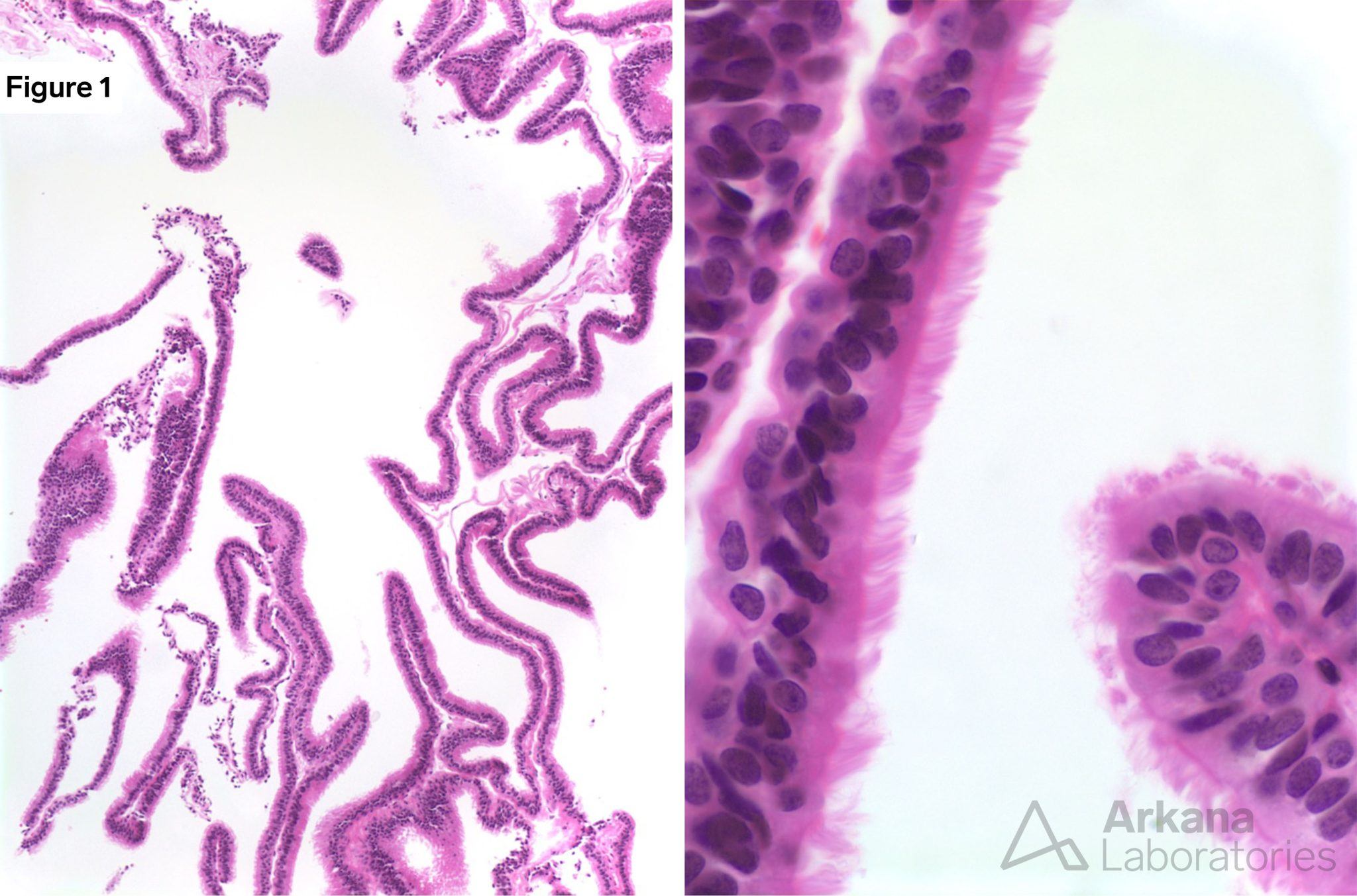Skull Base Cyst - Arkana Laboratories