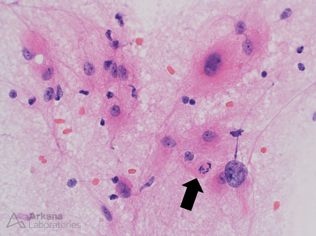 Squash Prep Astrocytic Neoplasm - Arkana Laboratories