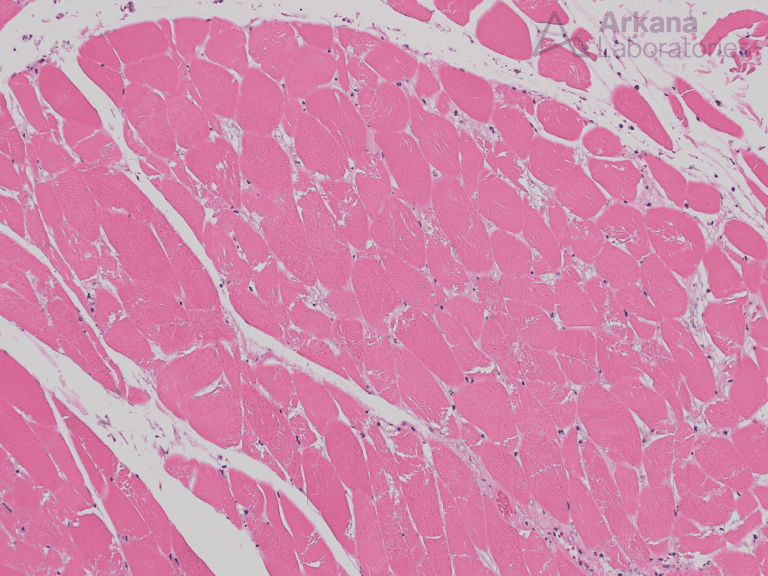 Patient with Painful Leg - Ischemic Myopathy | Arkana Laboratories